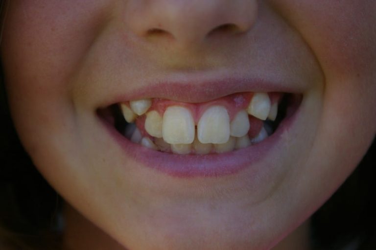Overbite vs Underbite: What’s the Difference?