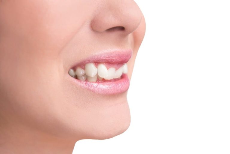 Overbite vs Underbite: What’s the Difference?